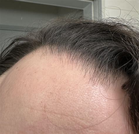 Am I Growing Hair On My Forehead Rtressless