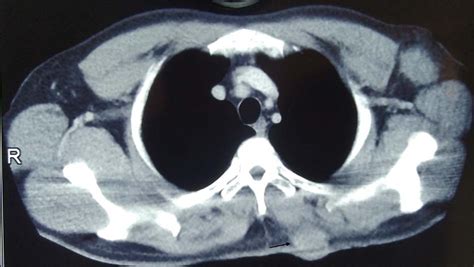Ct Image Showing Well Defined Lesion In Skin And Subcutaneous Tissue