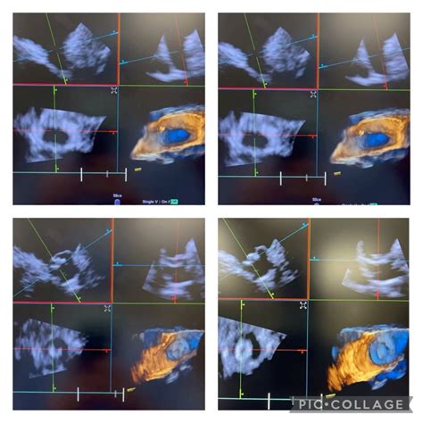 Mohammed Qintar Md Msc On Linkedin First 4d Ice Watchman Implantation In The State Of Michigan