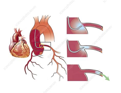 Cardiac Catheterization Illustration Stock Image C059 3336