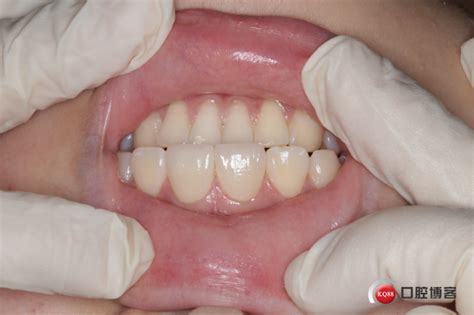 外伤冠折 铸瓷贴面修复 186hd1x8369的博客 Kq88口腔博客 外伤冠折 铸瓷贴面修复 186hd1x8369的博客 Kq88口腔博客