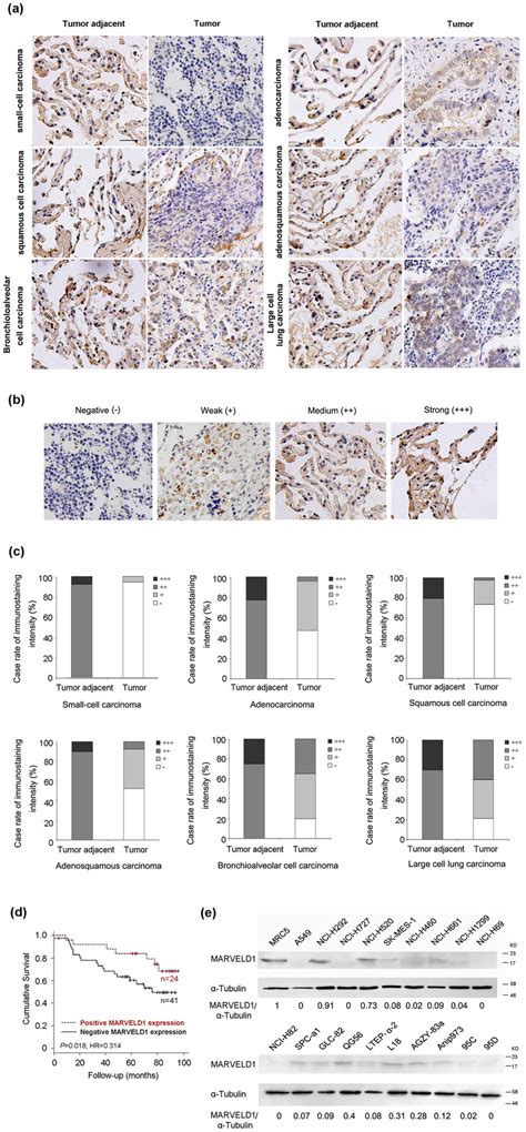 Marveld1 Expression In Lung Cancer Tissues And Cell Lines A