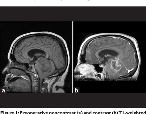 Figure 1 From Tectal Plate Glioblastoma Multiforme Semantic Scholar