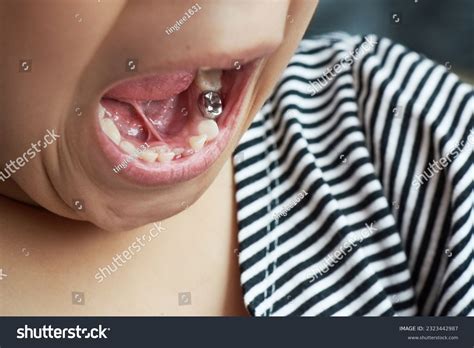 Silver Crown Tooth