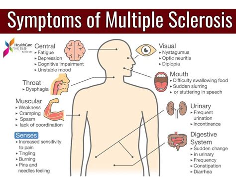 Seis claves para conocer la esclerosis múltiple Neurocirugía de la Torre