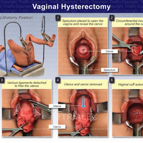 Vaginal Hysterectomy Trialquest Inc