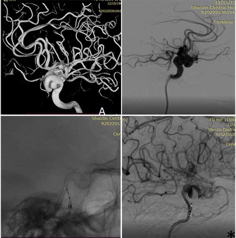 Trans Venous Approach For The Treatment Of Direct Carotid Cavernous Fistula Following Flow