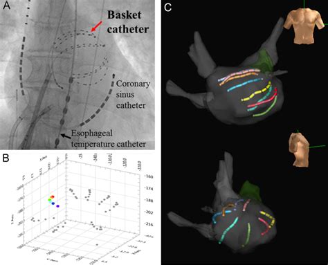 Localized Rotors And Focal Impulse Sources Within The Left Atrium In