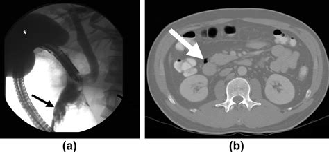 Image Guided Percutaneous Management Of Duodenal Perforation Following Endoscopic Retrograde