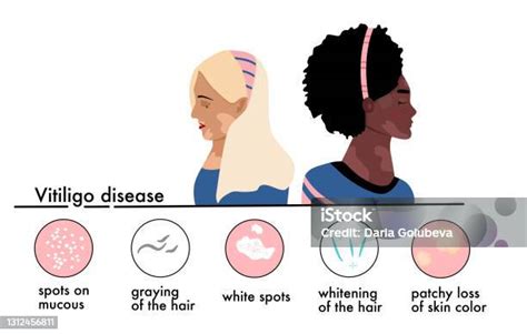 Hari Vitiligo Sedunia Remaja Putri Berbeda Etnis Dengan Penyakit Kulit