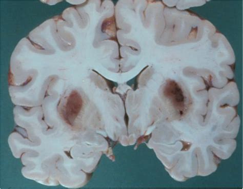 Pathology Outlines Methanol