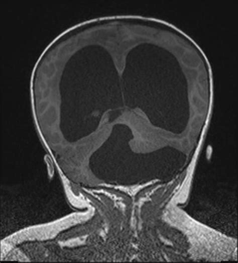 Dandy Walker Malformation Radiology Case