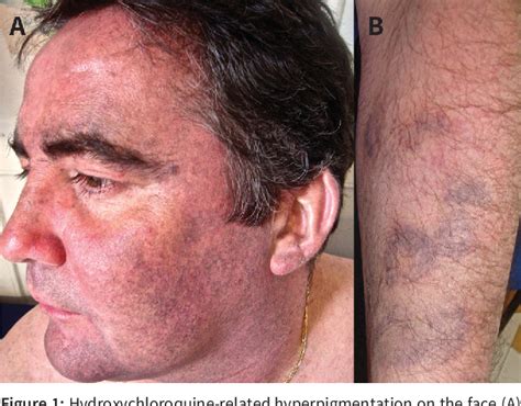 Figure 1 From Hydroxychloroquine Related Skin Discoloration Semantic