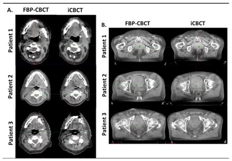 task based image quality assessment comparing classical and iterative cone beam ct images on