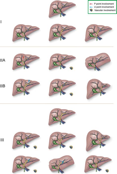 Schematic Diagram Of Preoperative 3dve Classification Of Hilar Download Scientific Diagram