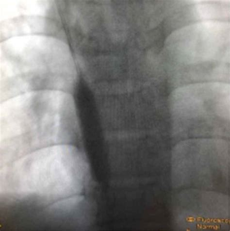 Fibrin Sheath Disruption Mozarc Medical