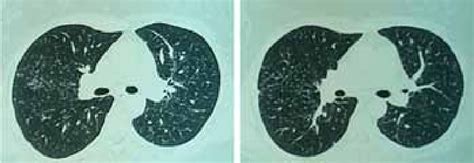 Computed Tomography Scan Of Chest Revealing Bilateral Perilymphatic