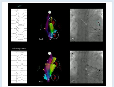 Example Of A Patient With Multiple Pvcs Pvc1 Top Circle