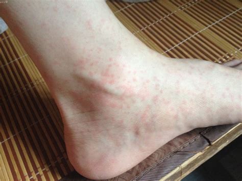 梅毒疹 44有来医生