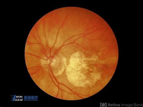 Myopic Macular Degeneration Retina Image Bank