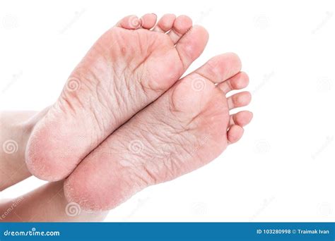 Female Legs With Overdried Dehydrated Dry Skin On Heels Closeup Stock