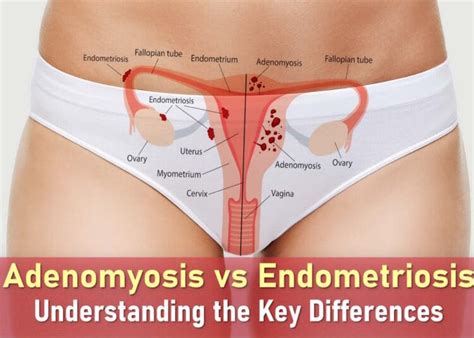 Adenomyosis Vs Endometriosis Understanding The Key Differences