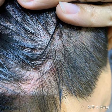 为什么头皮总是搔痒，皮肤科医生告诉你真相，帮你解决头痒问题 知乎
