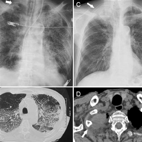 A X Ray Showing Bilateral Diffuse Reticular Shadows With A Nodular