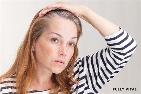 Frontal Fibrosing Alopecia Understanding And Solutions Fullyvital