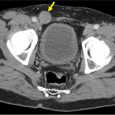 Axial Iv Contrast Enhanced Ct Image Through The Pelvis Shows A Soft