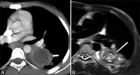 A And B Contrast Enhanced Axial Computed Tomography Of The Chest A