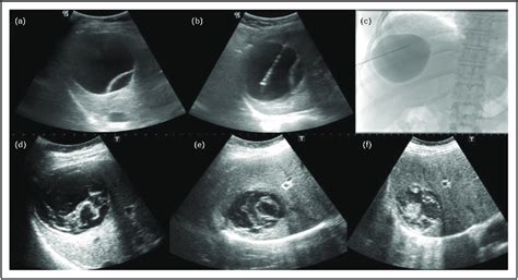 Pair A 26 Year Old Male Patient With Ce 1 Type Hydatid Cyst In Us