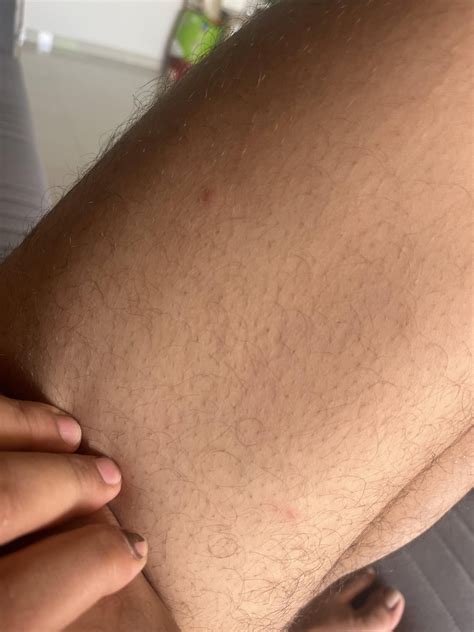 Is This Std Rash R Dermatologyquestions