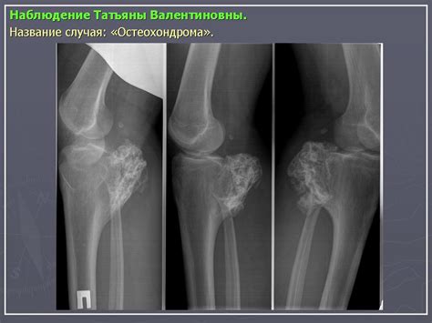 КСС Остеохондрома костно хрящевой экзостоз Набор изображений