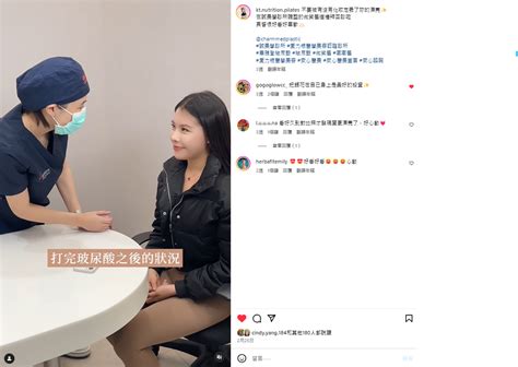 誠美學診所美麗見證 玻尿酸微笑唇 網紅 營養師katie凱蒂