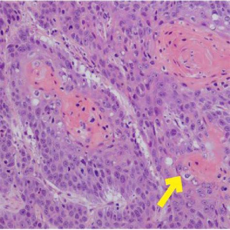C High Power View Of Keratin Pearls Characteristic Of Squamous Cell