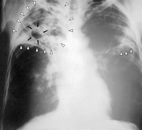 Ghon Complex Ghon Focus Definition Chest X Ray And Causes