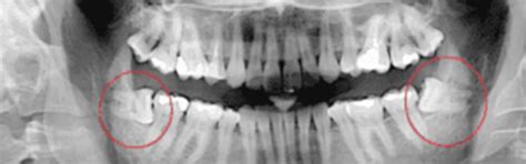 What Does An OPG Test Detect