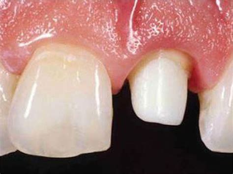 Ultracore Core Build Up Vincismile