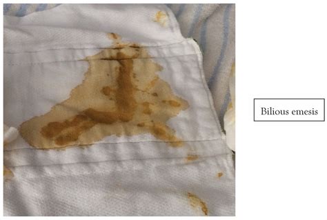 Coffee Ground Puke