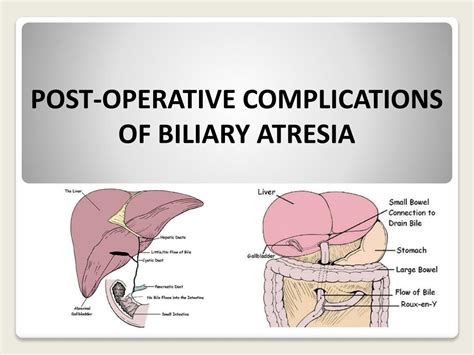 Ppt Post Operative Complications Of Biliary Atresia Powerpoint