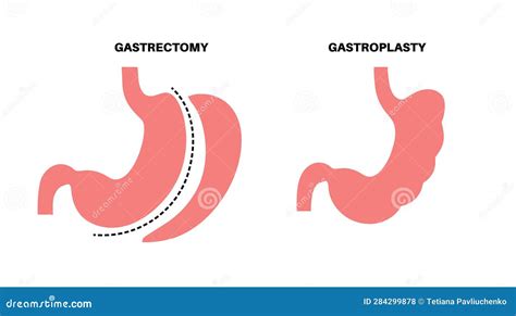 Gastrectomy And Gastroplasty Stock Vector Illustration Of Bariatric