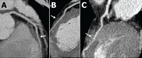 Forty Years Of Chest Pain A Case Report And Contemporary Review Of The Diagnostic And