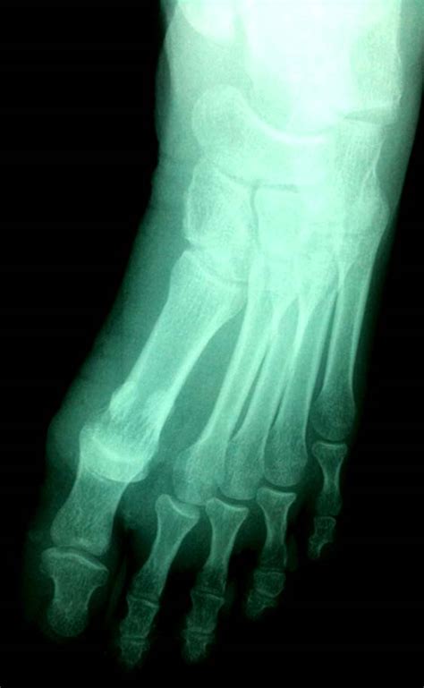Plantar Dislocation Of The First Metatarsophalangeal Joint