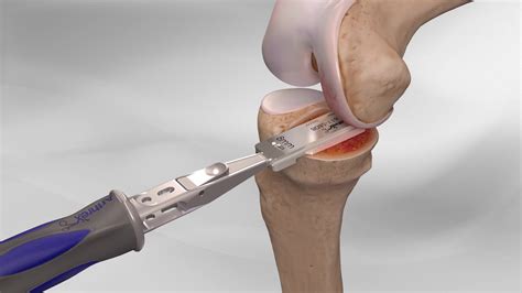 Arthrex Unicondylar Knee Arthroplasty Uka