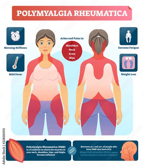 Polymyalgia Rheumatica Vector Illustration Labeled Diagnosis Diagram