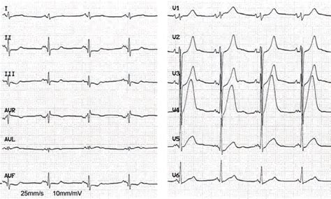 T Wave And Ischemia Ecg Book