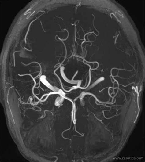 Vascularisation Cérébrale Et Polygone De Willis