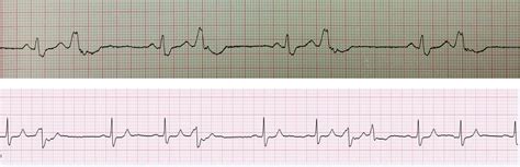 Multifocal Premature Ventricular Contraction