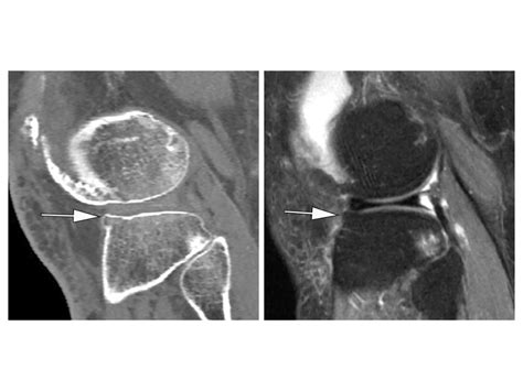 Bicl Researchers First To Validate Mri For Osteophyte Assessment — Bicl